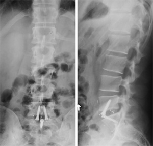 Anterior Lumbar Interbody Fusion | Sierra Neurosurgery Group